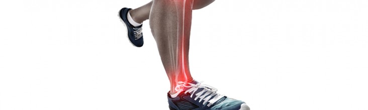 Shin Spilts – Streetsville Orthotic Clinic
